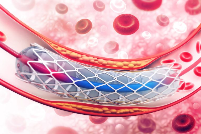 STENTS: TYPES, PROCEDURE & BENEFITS | Add More to Life - Meril