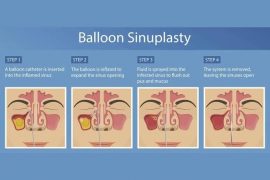 Balloon Sinuplasty: A Minimally Invasive Procedure To Treat Chronic ...