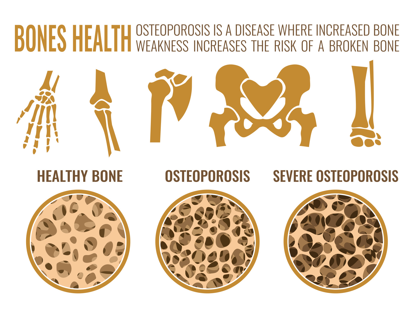 A Comprehensive Guide To Understanding Osteoporosis Add More To Life