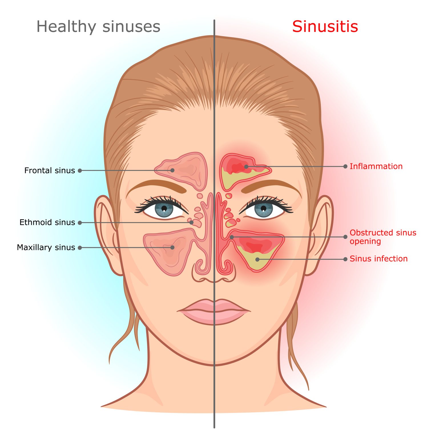 Sinus Infection: Warning Signs And Symptoms When to See a Doctor for ...